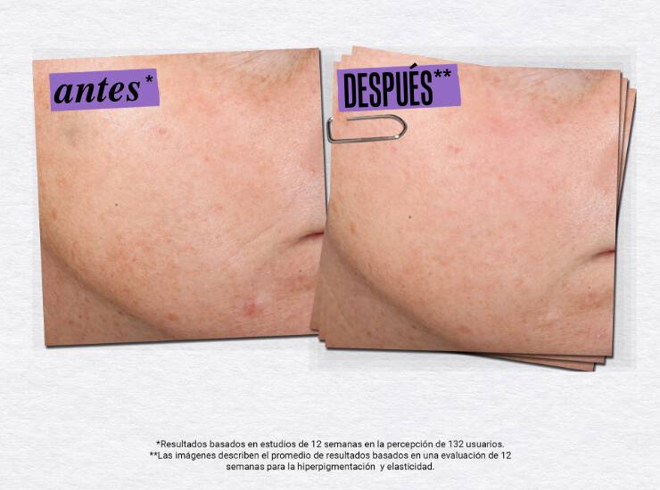 Flacidez facial: Causas, síntomas y cómo recuperar su firmeza